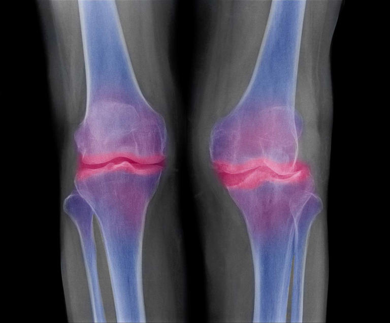 How an osteophyte (bone spur) develops
