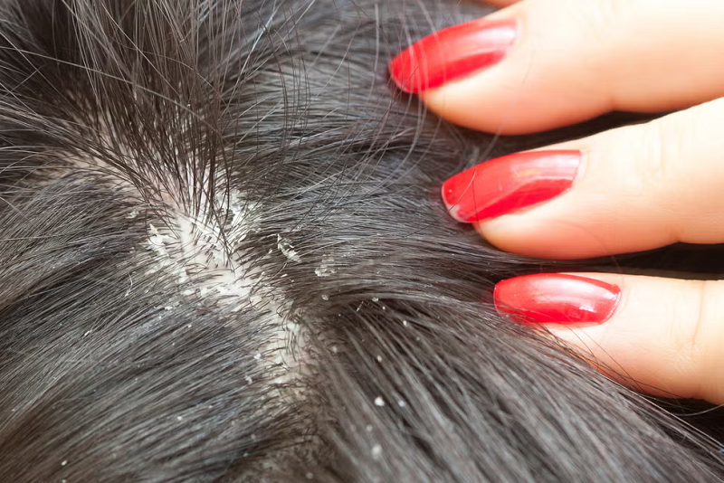 Follow these Ayurvedic tips to get rid of dandruff, the effect will be ...