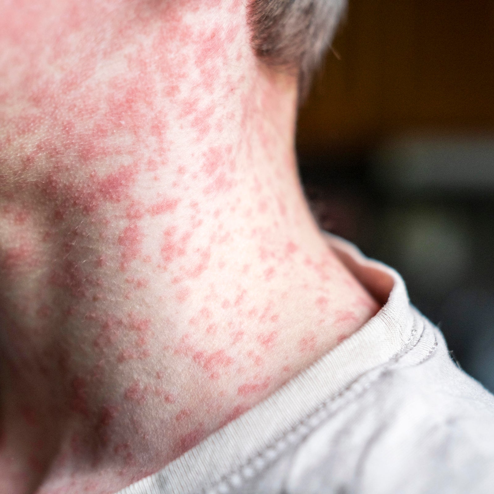 Kansas reports measles outbreak with 23 cases