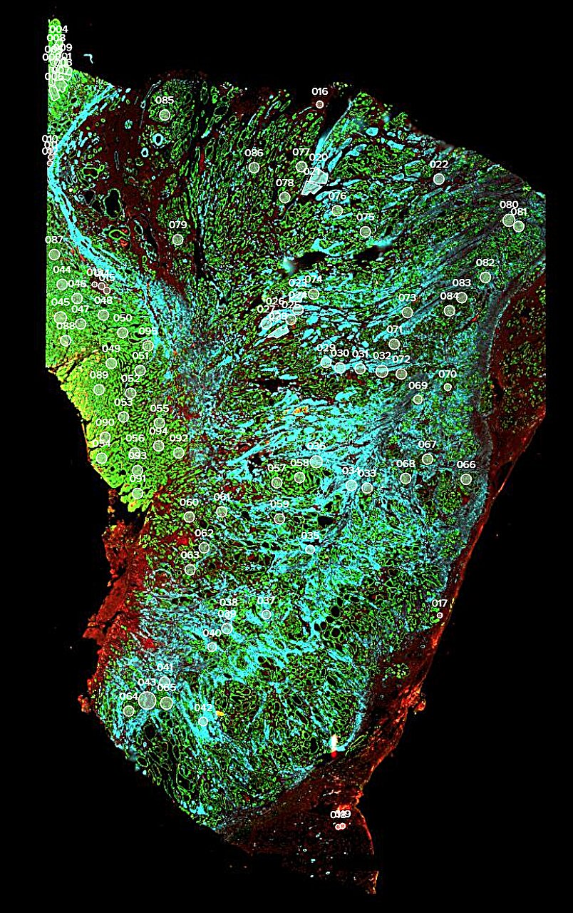 Scientists map tumors for better, more precise treatments in stomach cancer