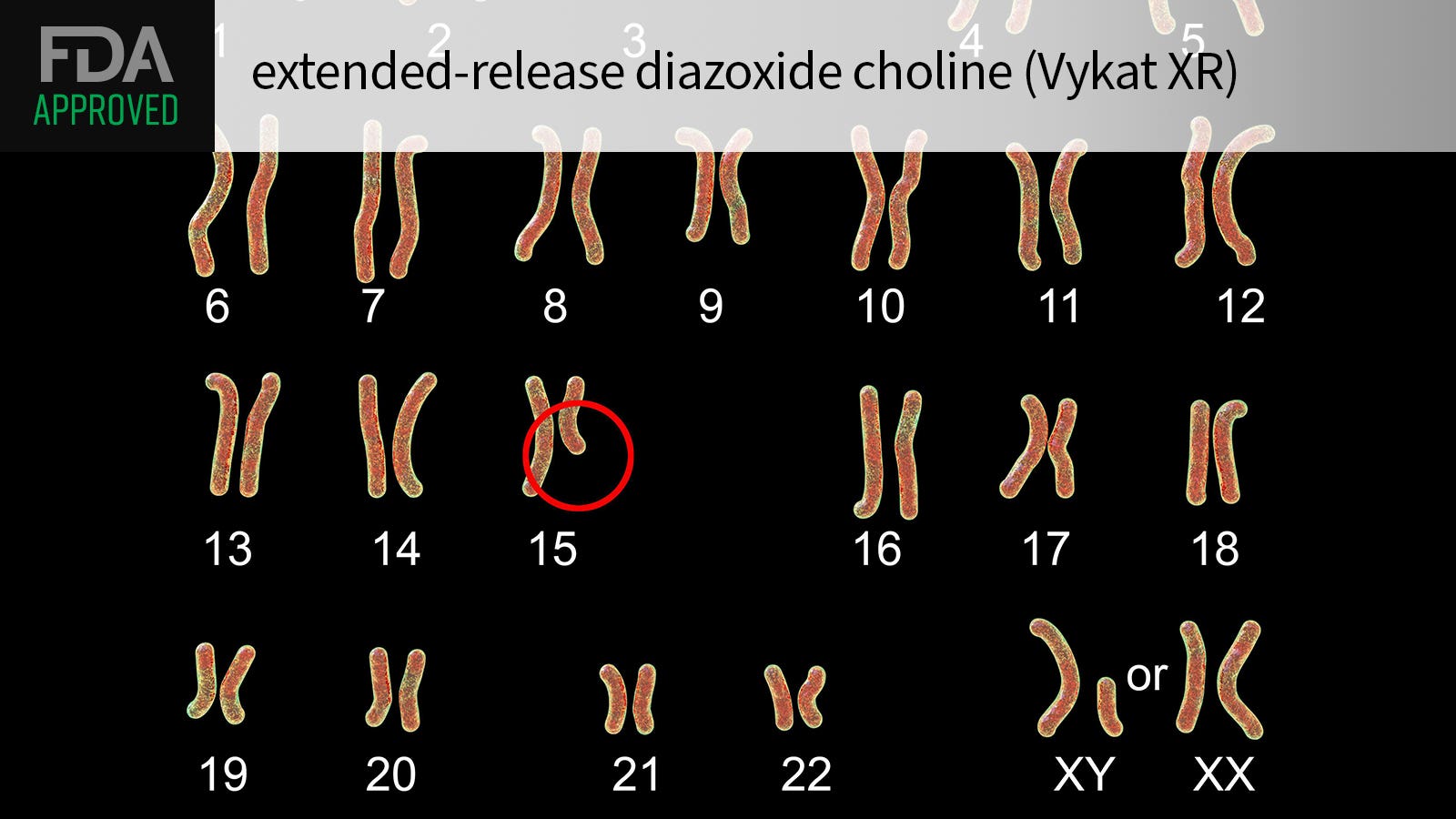 FDA OKs First Drug for Hyperphagia in Prader-Willi Syndrome