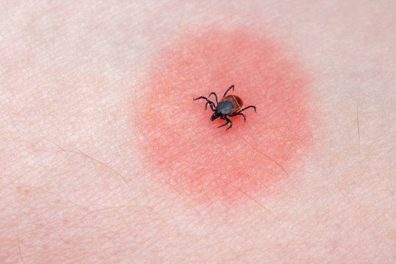 NHS shares step-by-step guide to remove ticks in new Lyme disease message