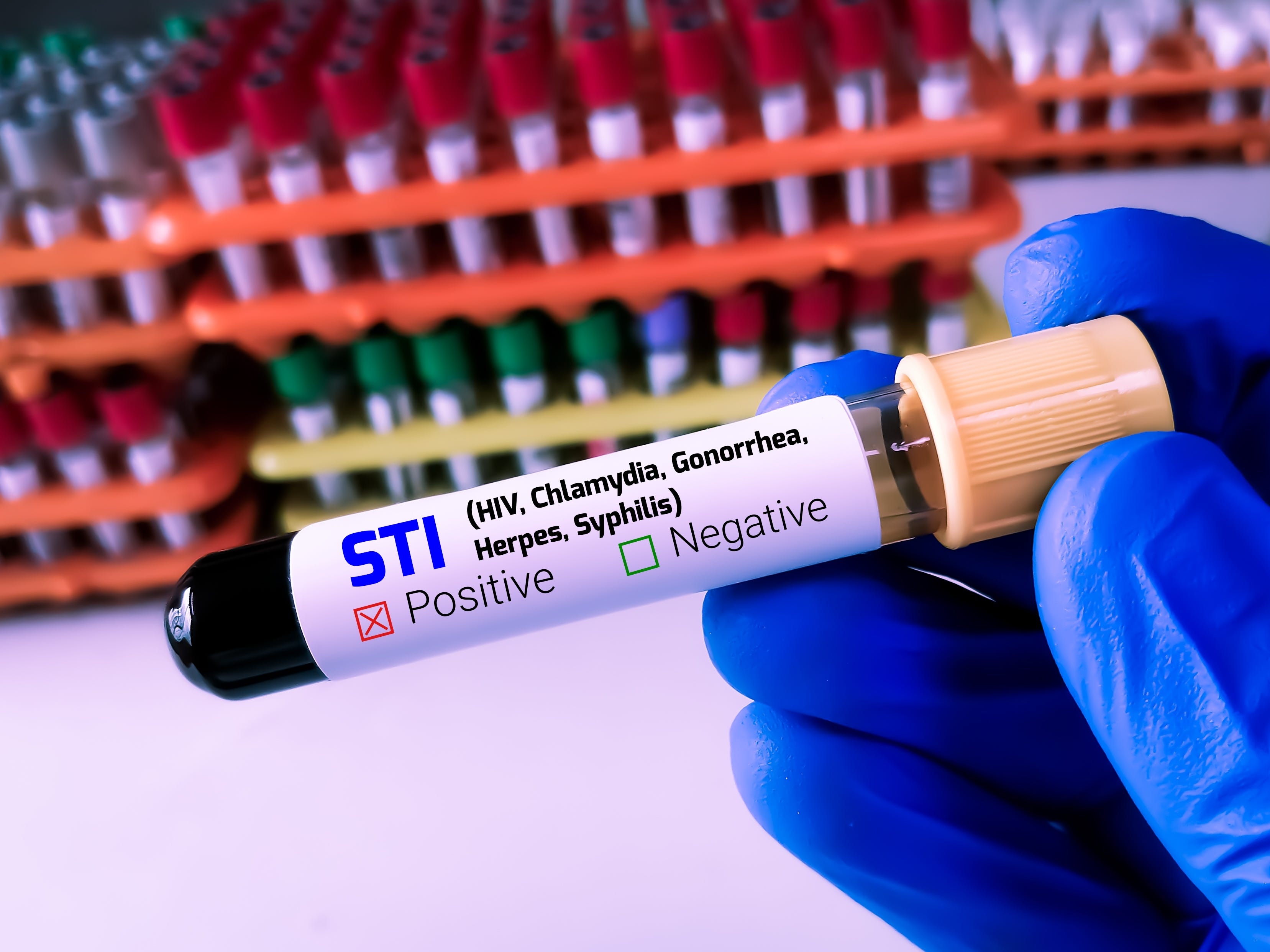 FDA approves first at-home, over-the-counter test for STIs. But it's ...