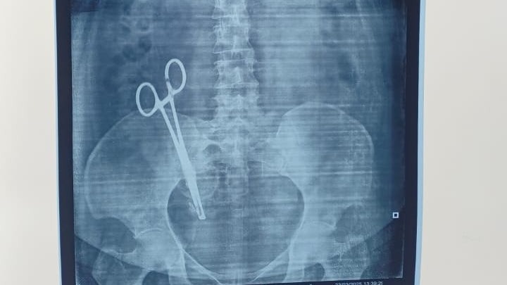 Scissors left in woman's stomach during C-section, removed after 17 years