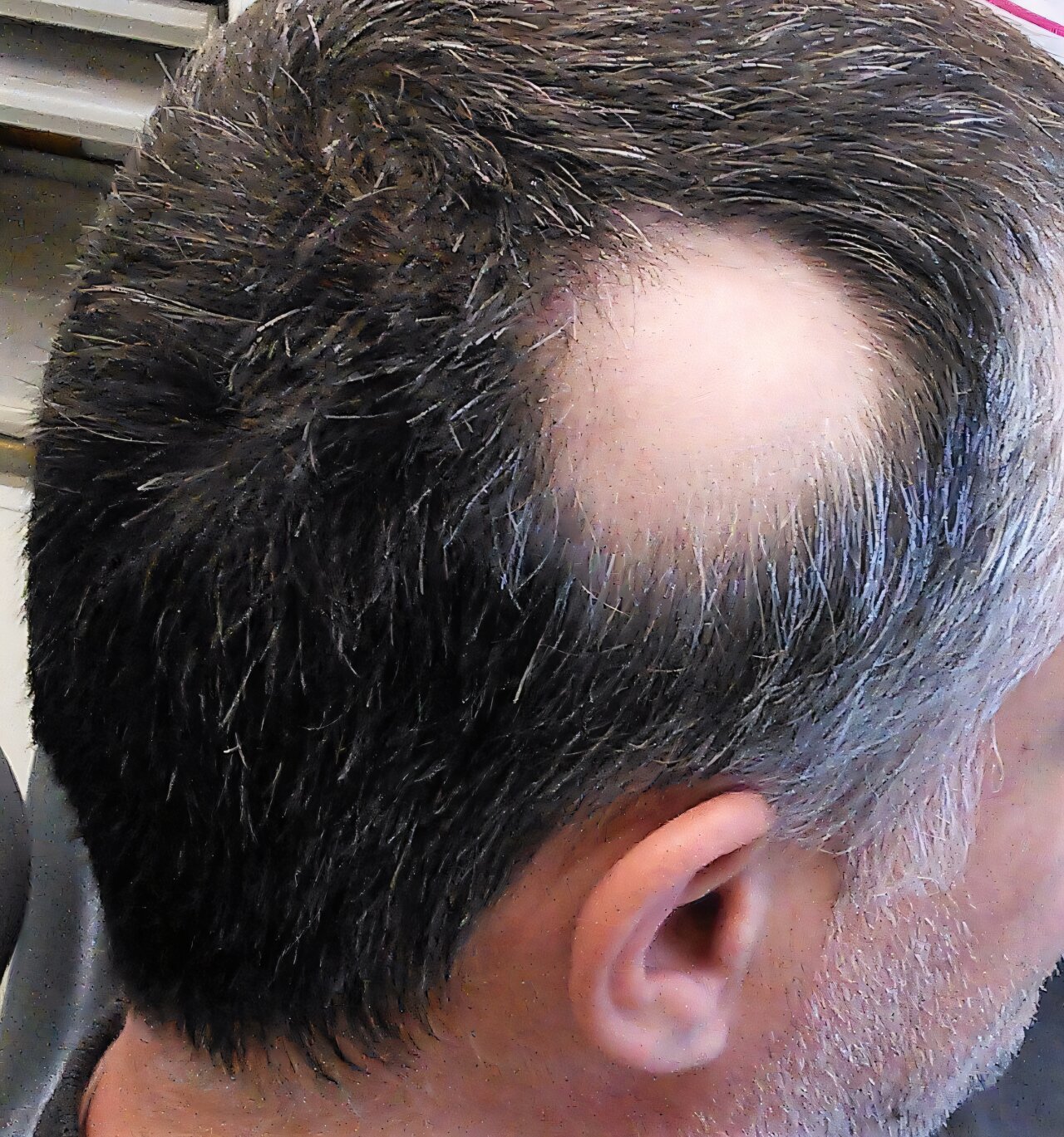 New study reveals protector protein that supports hair regrowth in adults