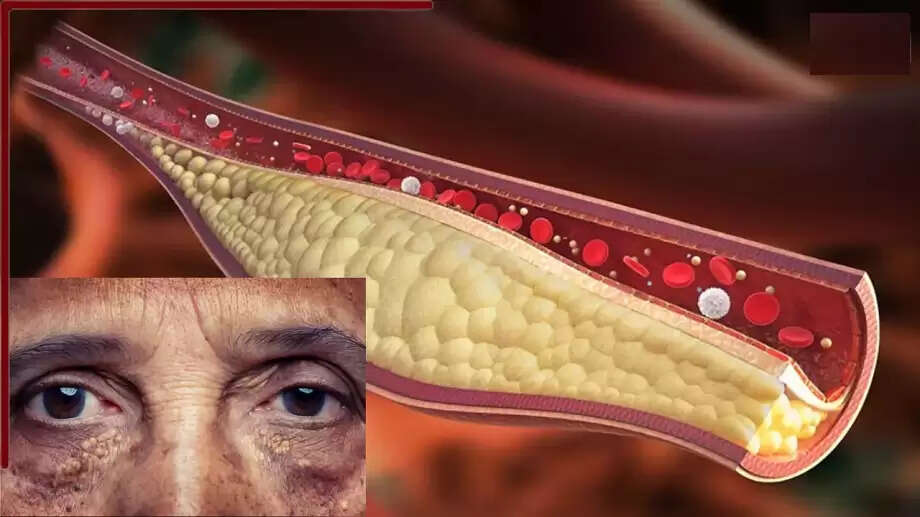 These signs visible on the face tell that cholesterol has now crossed ...