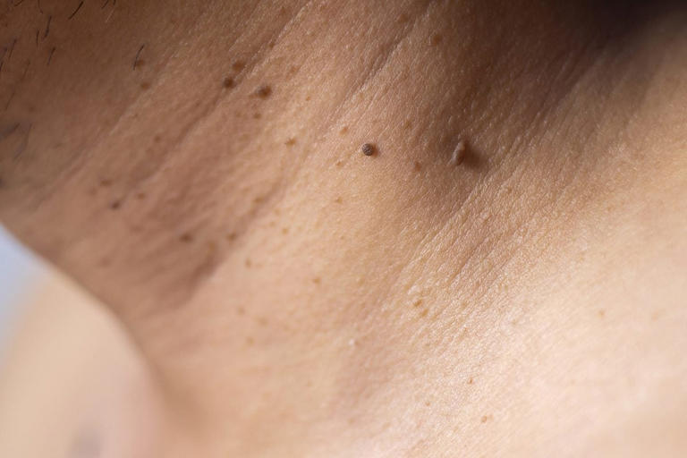 How to Get Rid of Skin Tags the Right Way, According to Expert ...