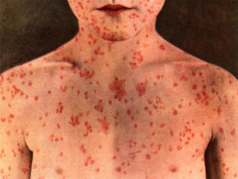 Three new measles cases confirmed in Taber, all reportedly linked to ...