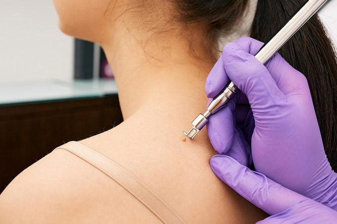 How to Get Rid of Skin Tags the Right Way, According to Expert ...