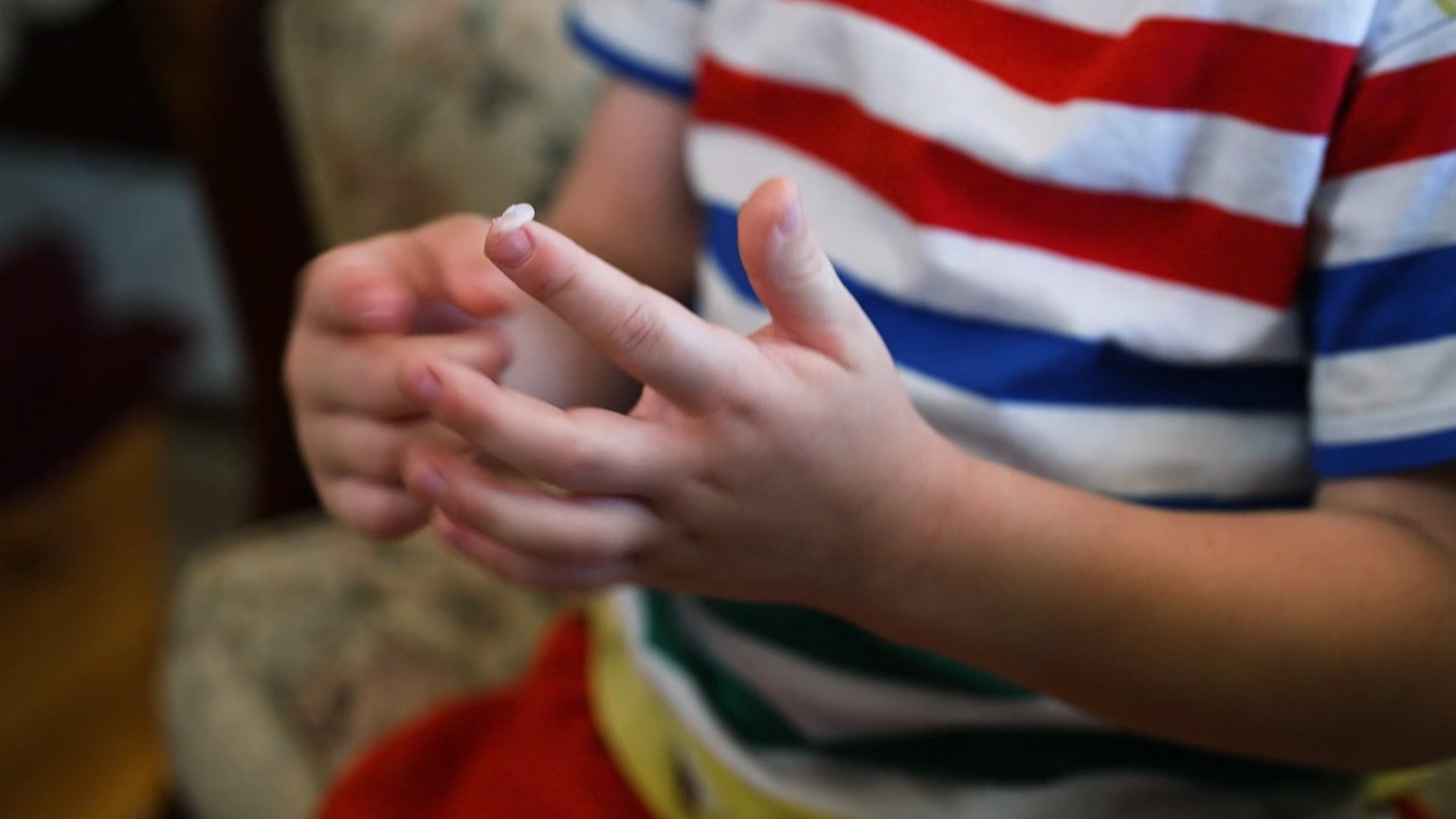 Nikki's baby had a common rash. She says withdrawal from the treatment ...