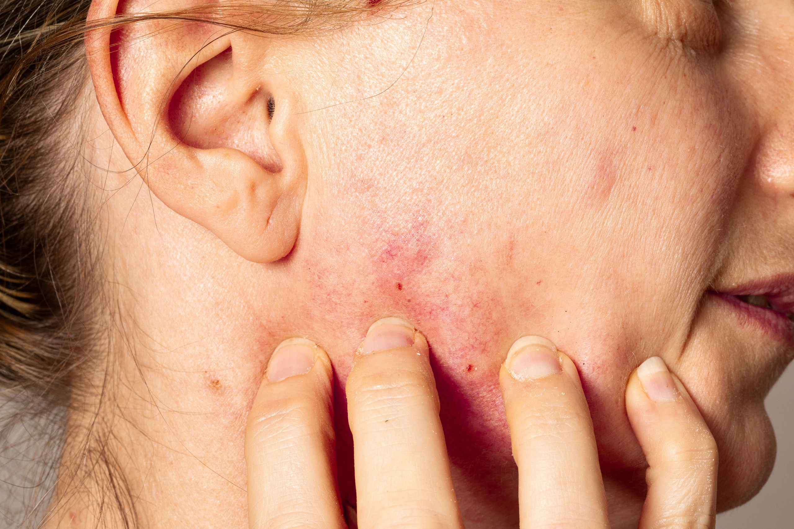 Facing up to the skin condition called rosacea