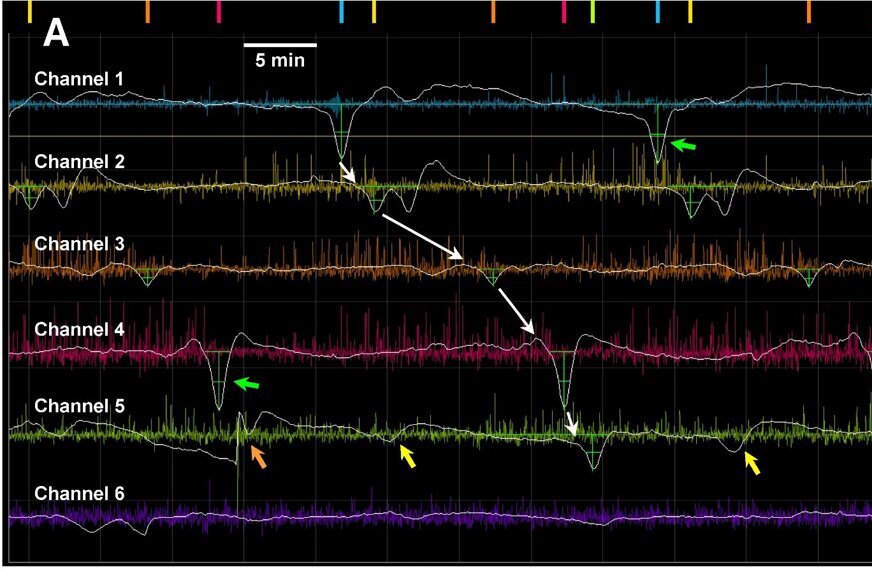 The 'brain tsunami': Machine learning aids in detection of abnormal ...
