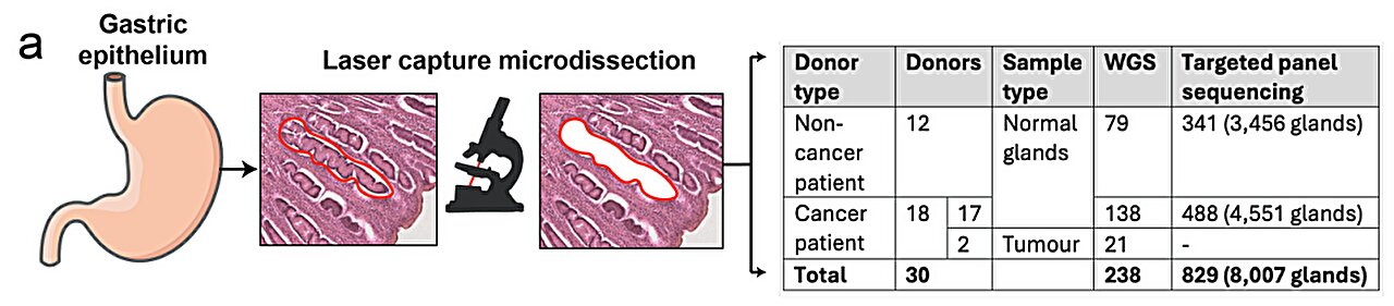 Earliest stages and possible new cause of stomach cancer revealed
