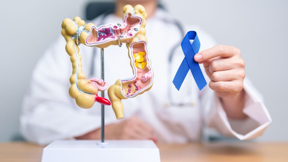 Colorectal cancer cases rise among younger adults, UW research shows
