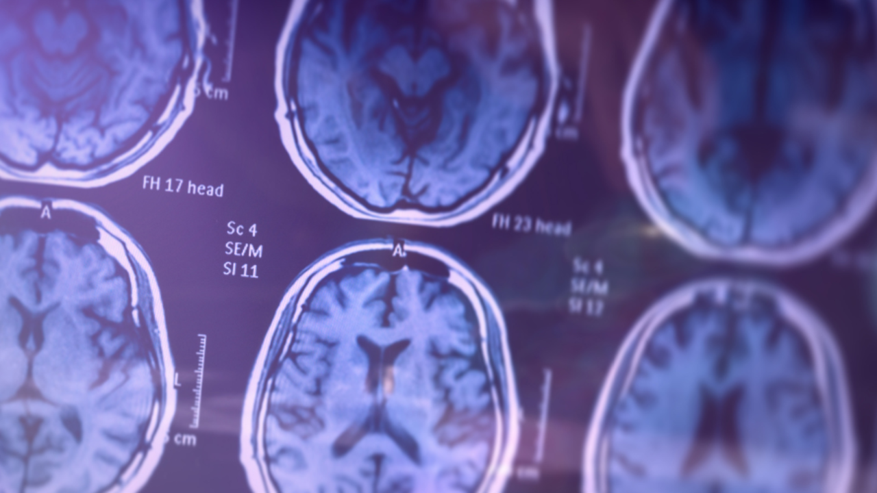 Is 'Sticky Gunk' In Your Brain The Reason Behind Alzheimer's Disease?