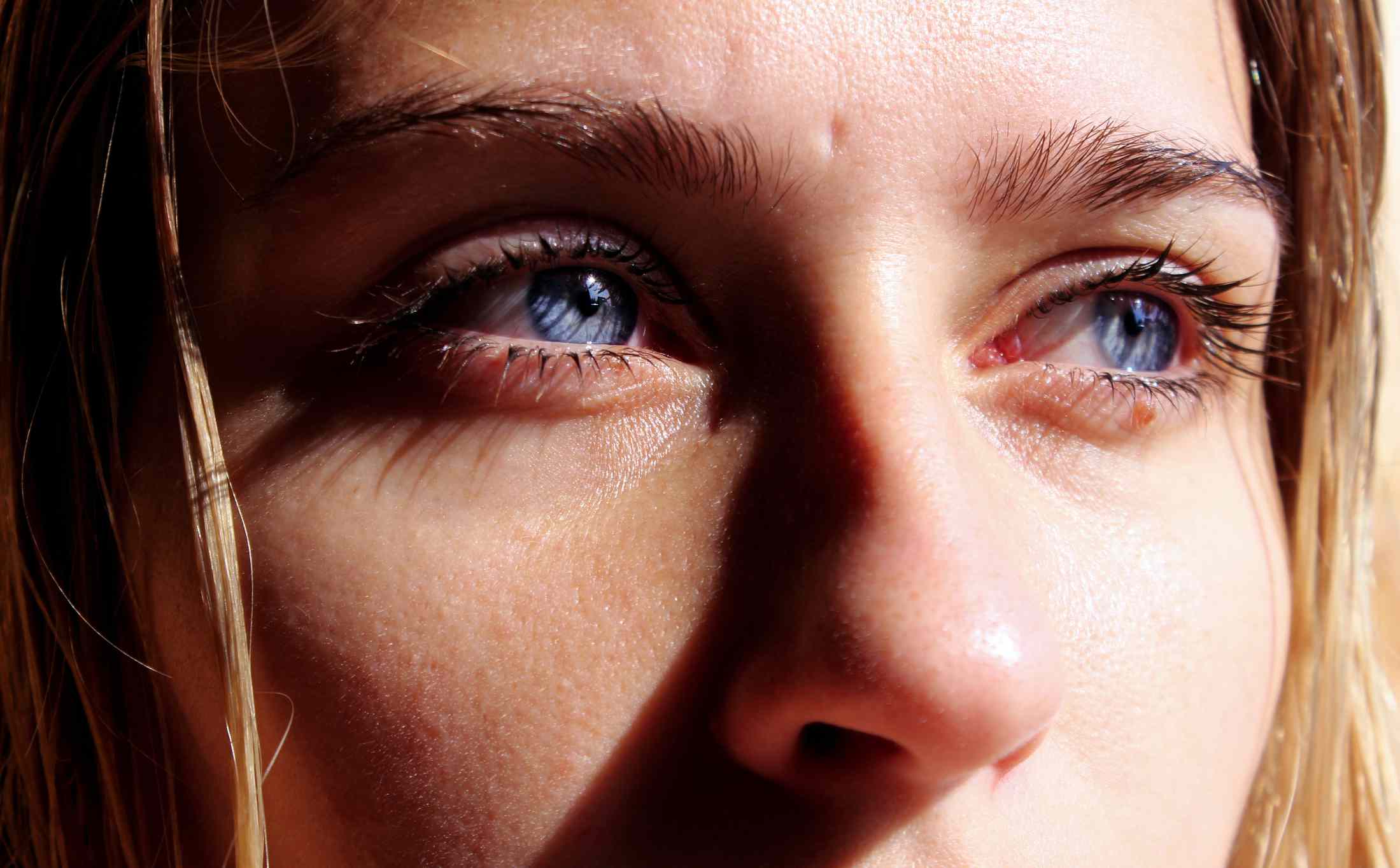 Are Blue Eyes More Sensitive To Light? Understanding Photophobia