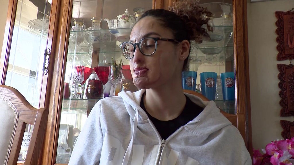 Long Island acid attack survivor Nafiah Ikram says "every day is a ...