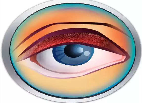 Surgery that reduces pupil to pinhole offers alternative to corneal ...