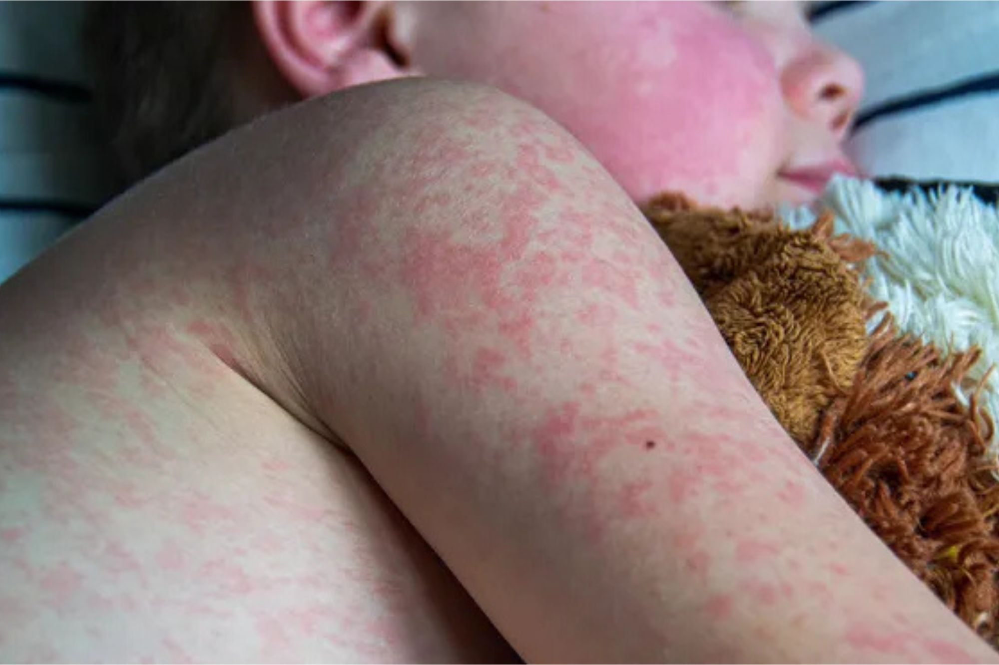 Anti-Vaxx Mom Whose Daughter Died From Measles Says Disease 'Wasn't ...