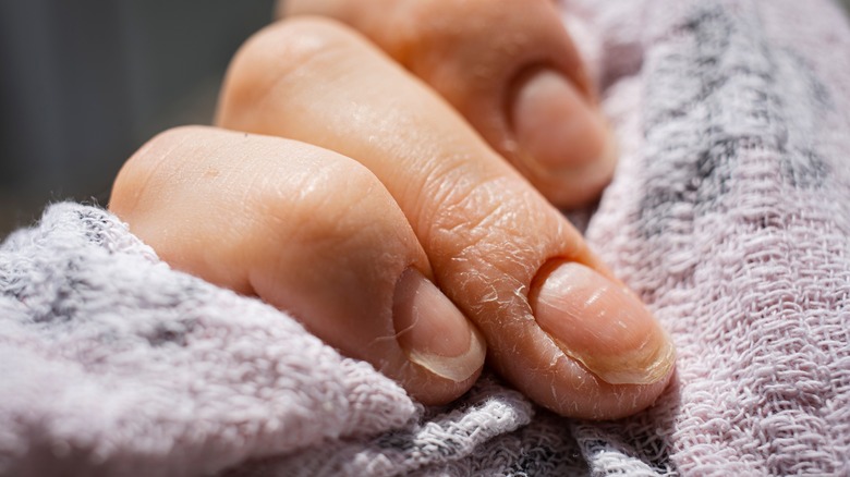 Fingernail Ridges: Causes And Treatments For Vertical And Horizontal ...