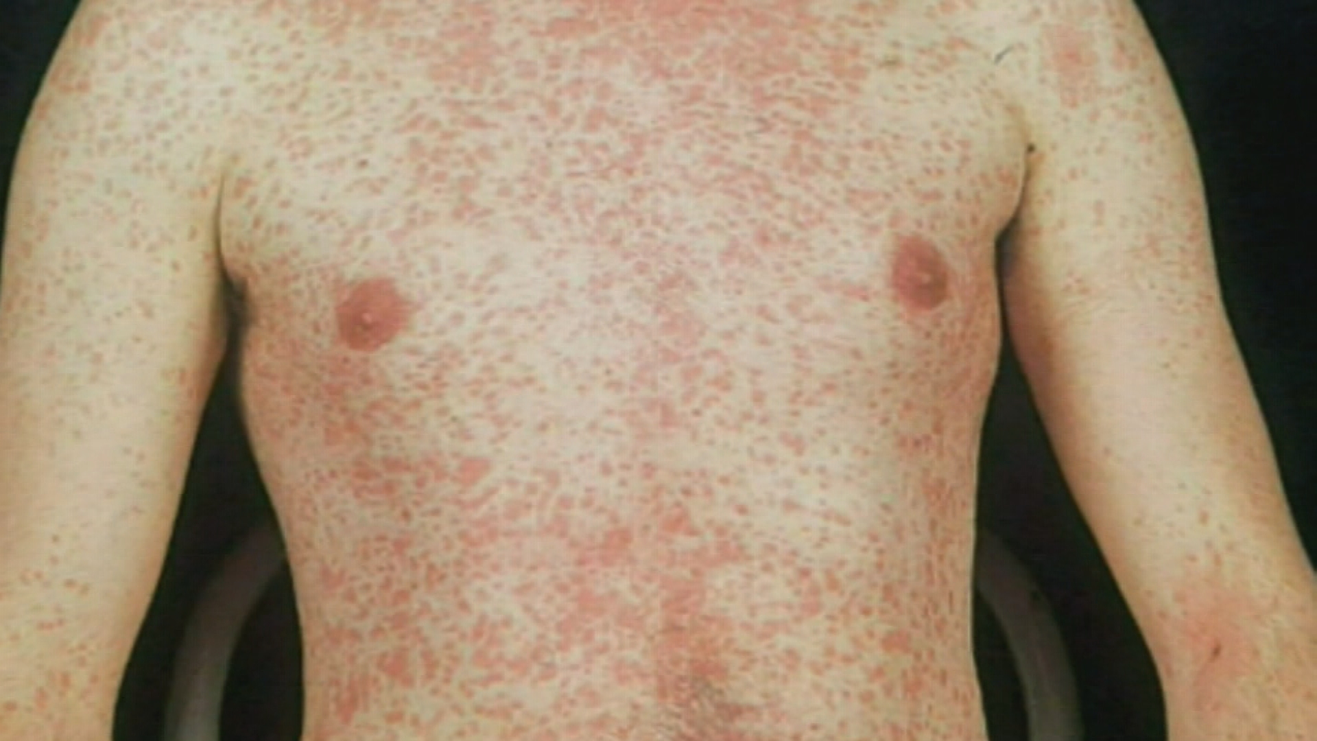 Health warning after measles case identified in Perth