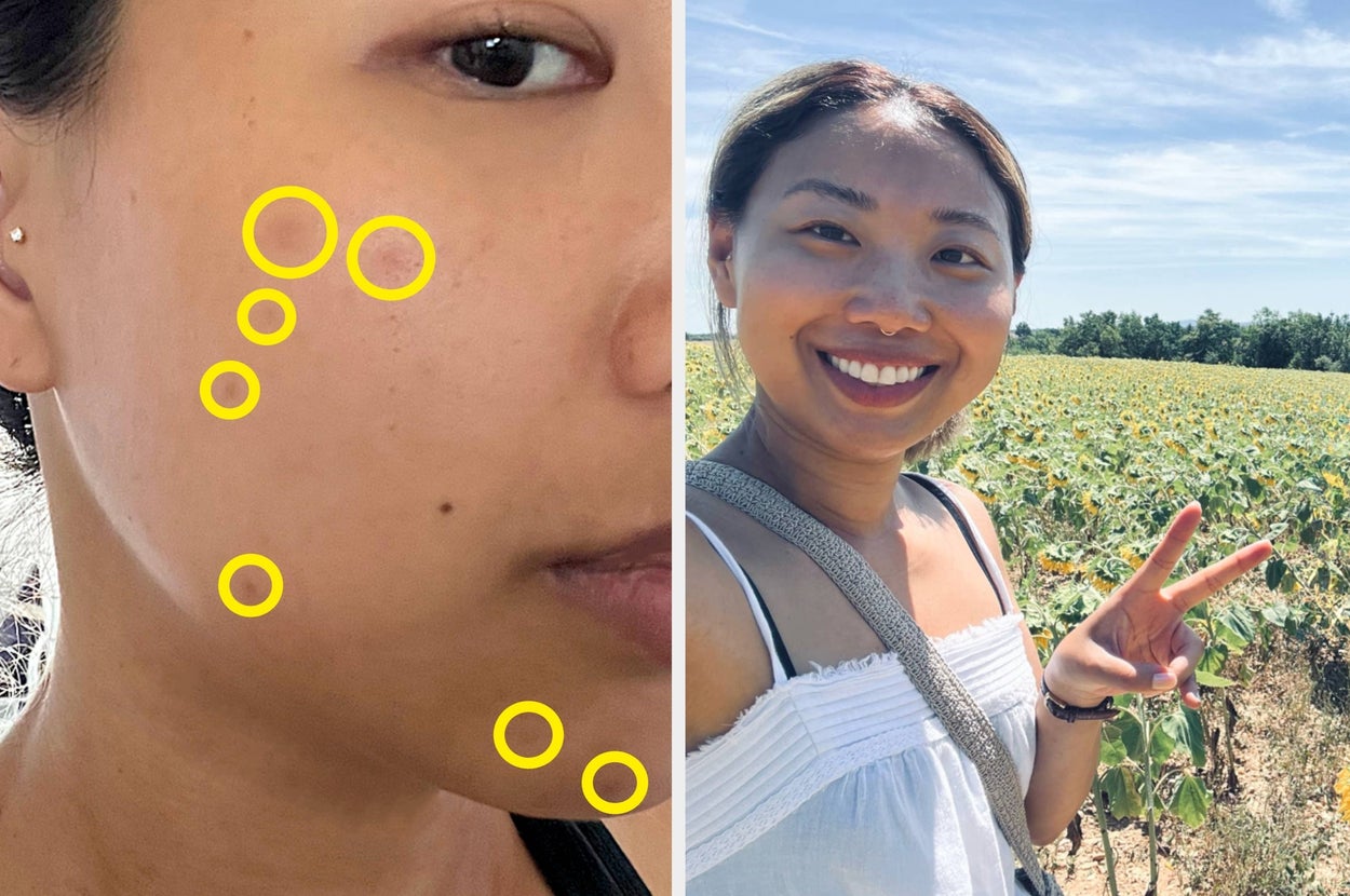 After My Acne Flared Up On Vacation, A French Pharmacist Helped Clear ...