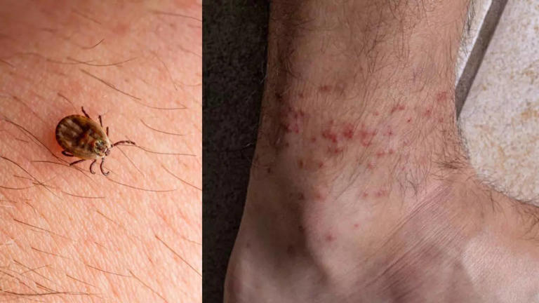 Meat Allergy Caused by Ticks Pops Up In the US; Know All About the ...