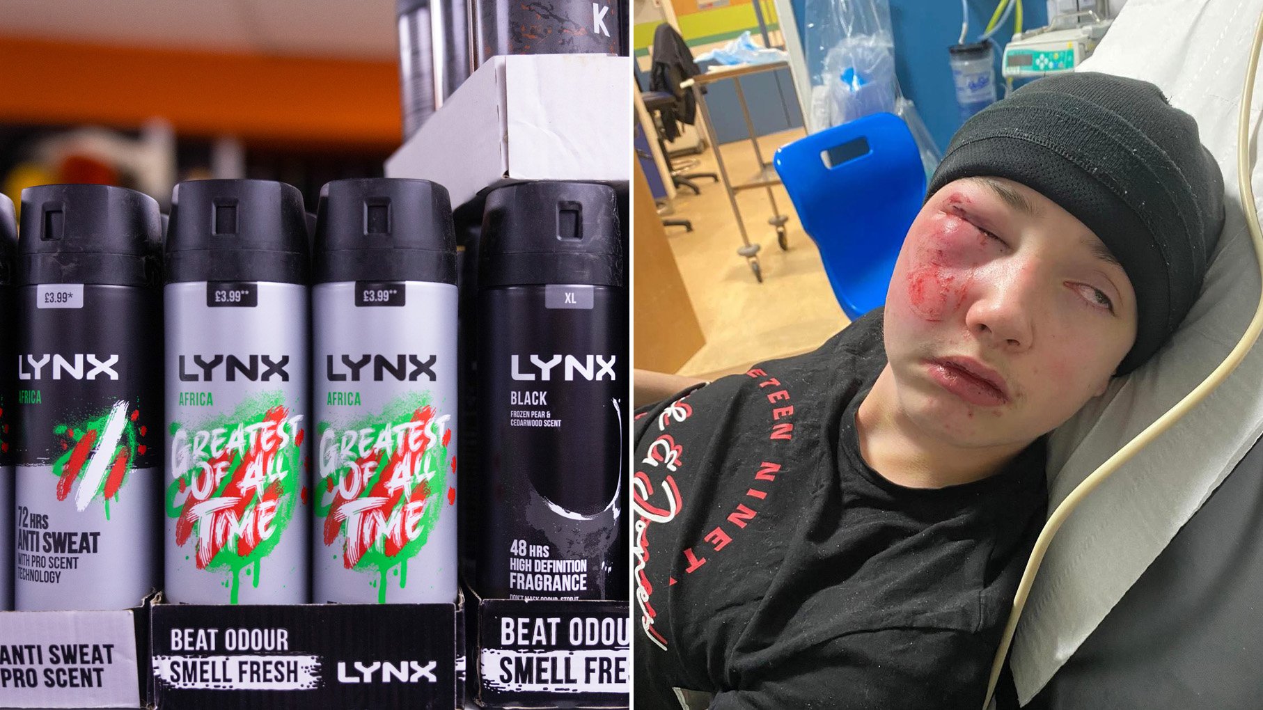 Horrific injuries of boy, 12, after Lynx can thrown into fire ‘exploded ...