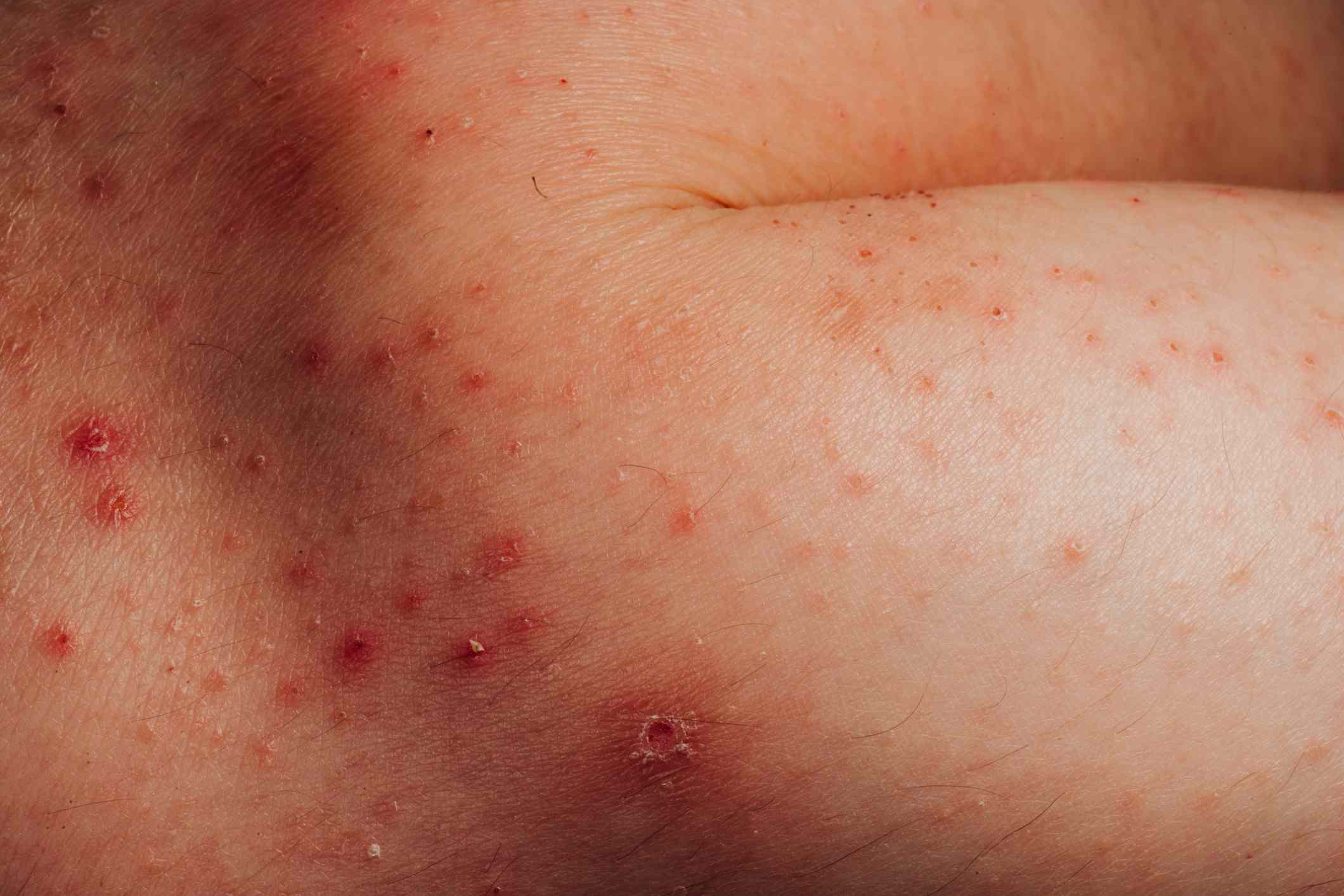 Eczema before, during, and after menopause