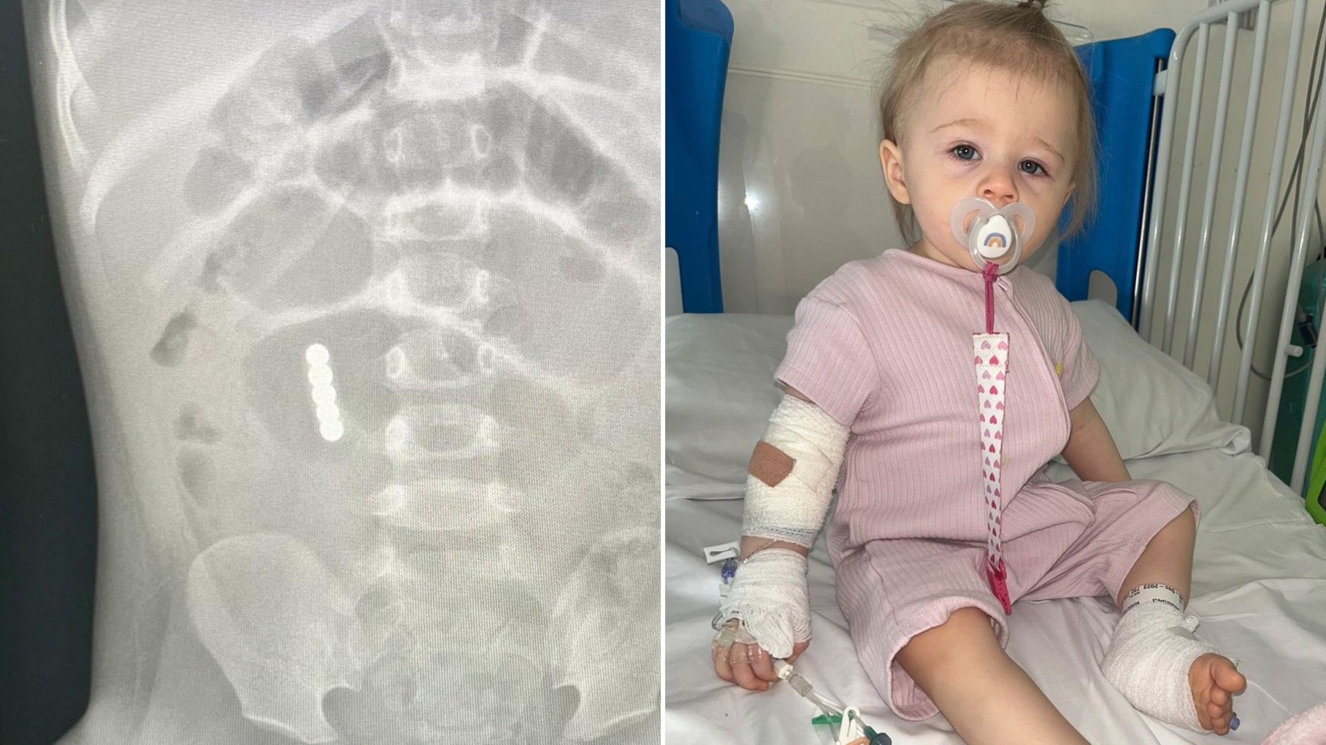 Baby almost dies and has part of bowel removed after swallowing toy magnets