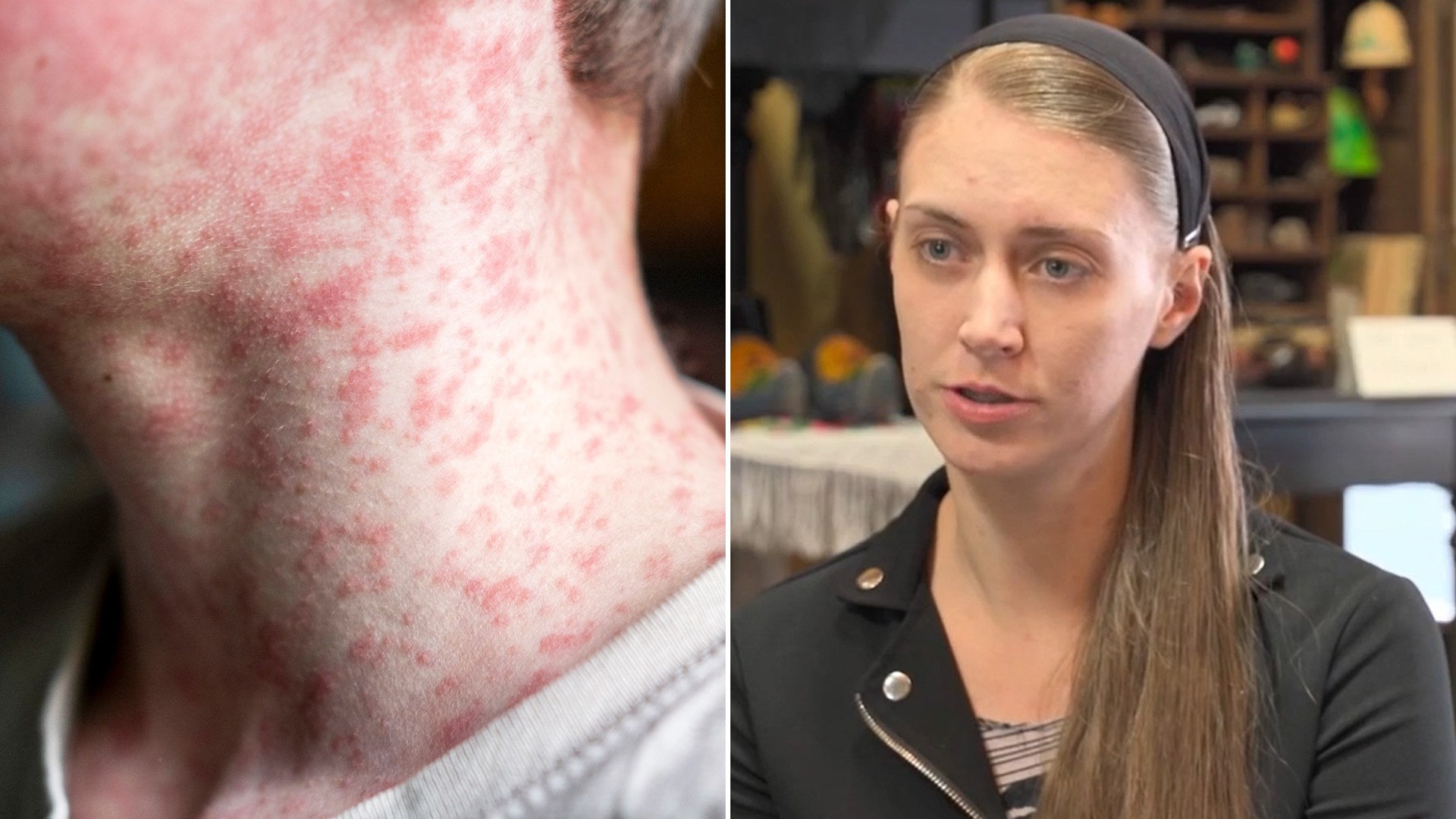 Anti-vax parents 'have no regrets' after daughter died from measles