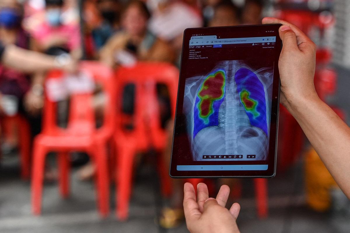 DOH targets to screen 12M Filipinos for TB by 2026
