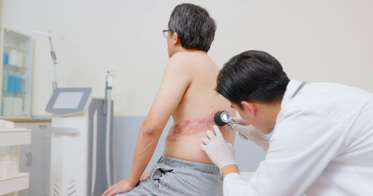 What is shingles? What are shingles symptoms?