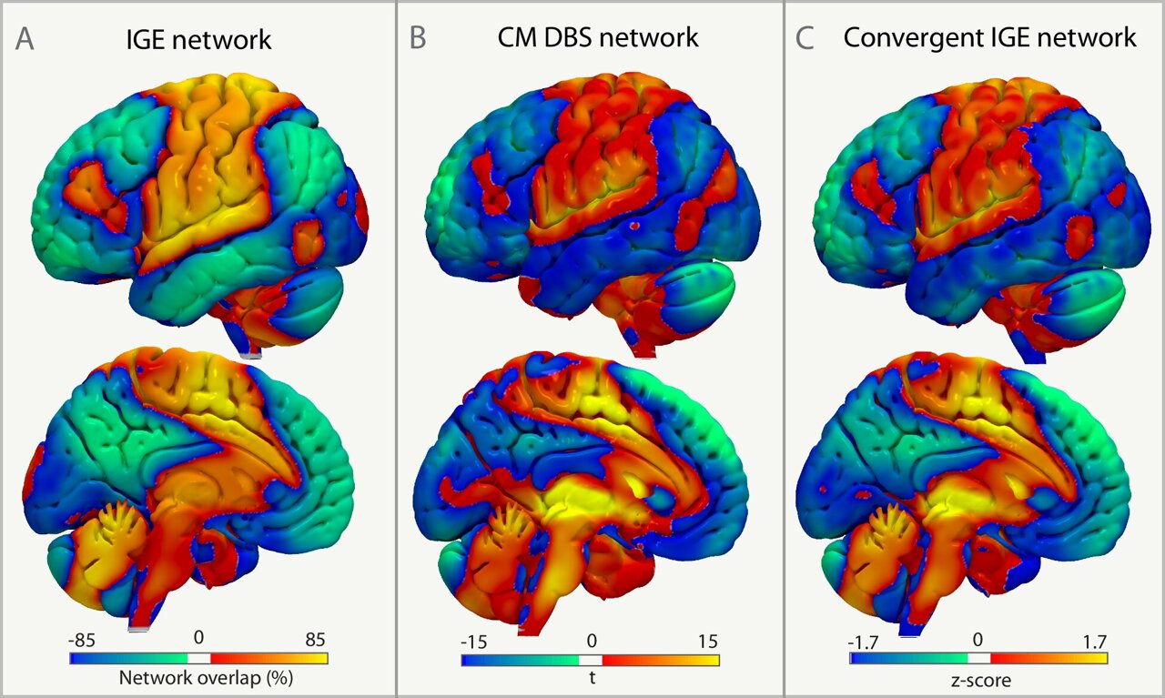 Scientists map brain network linked to generalized seizures, paving way ...