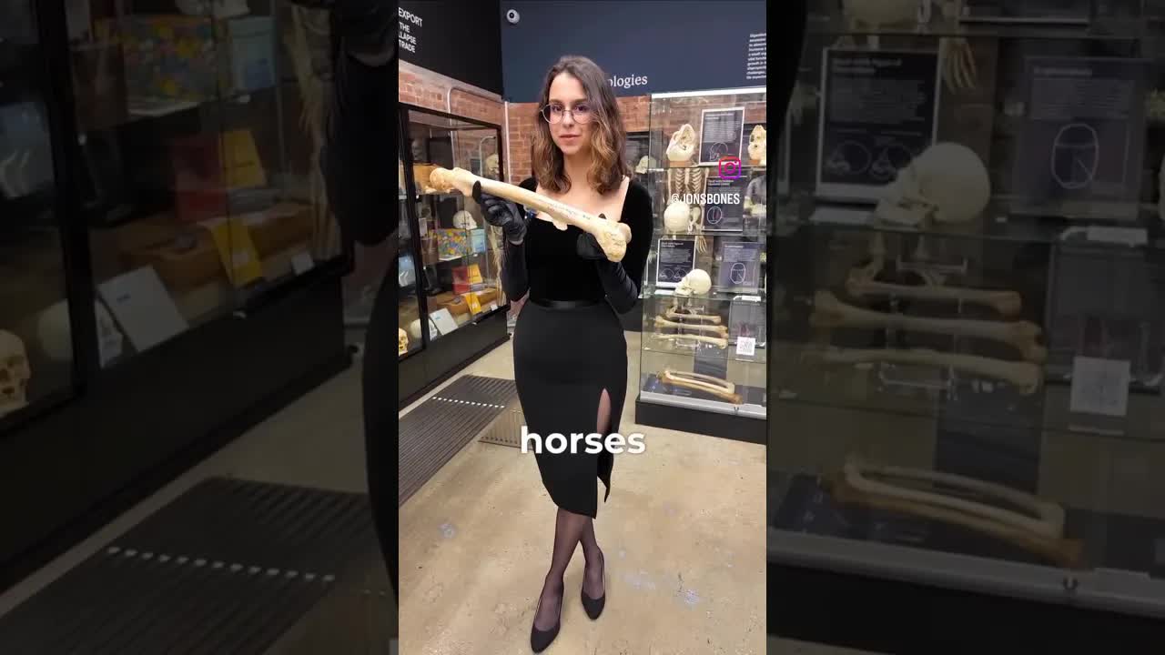 Rider's Bone: A Rare Exostosis Explained