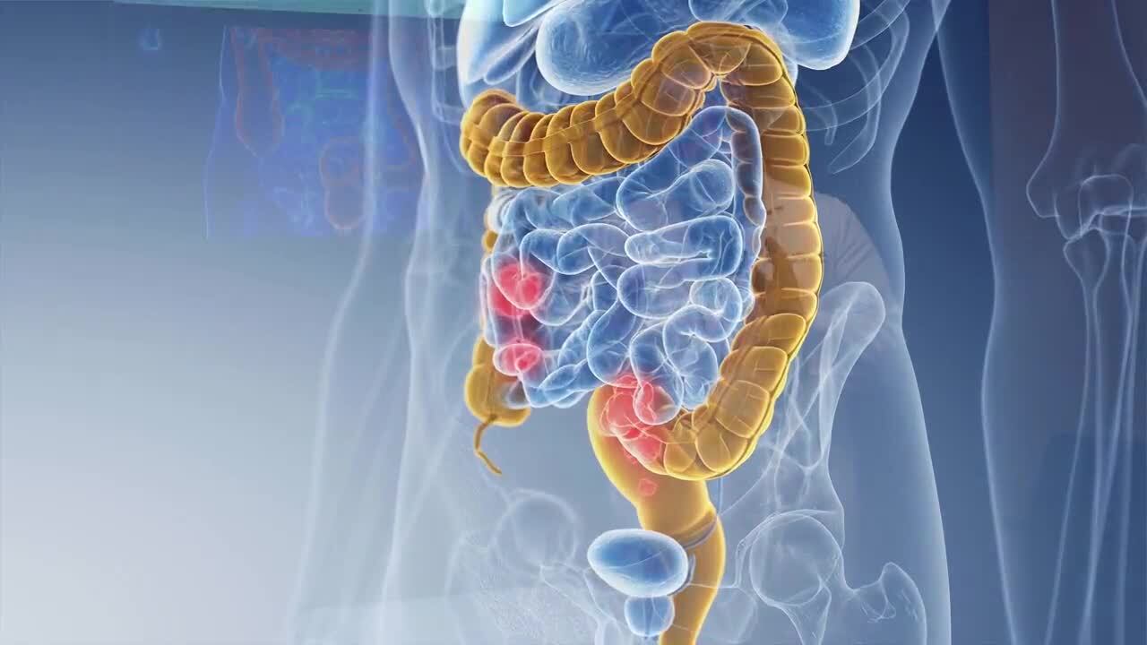 Free colon cancer screening kits available in Lincoln and Lancaster county