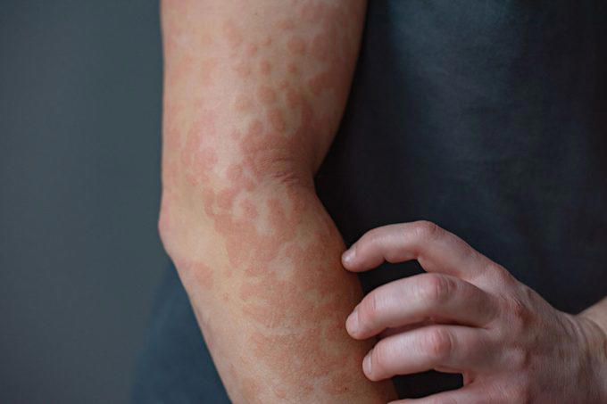 Is It Hives or a Rash? Here’s How to Tell the Difference