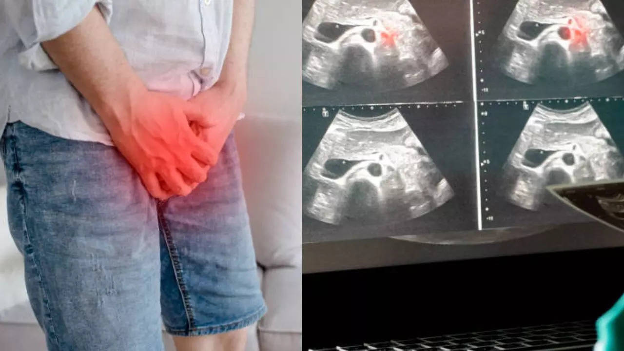 Micro-Ultrasound Shows MRI-Level Accuracy In Detecting Prostate Cancer