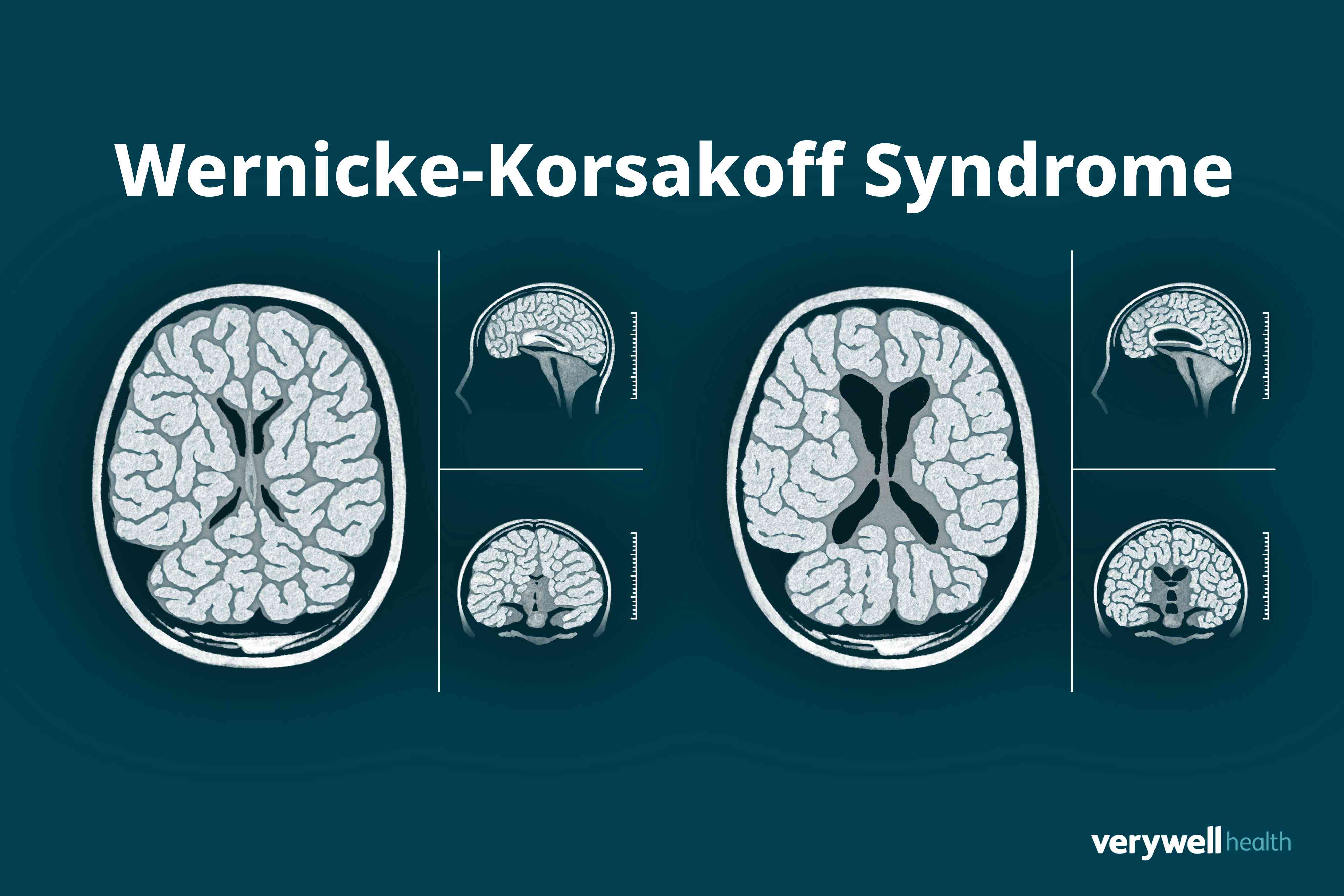 How Wernicke-Korsakoff syndrome affects the brain