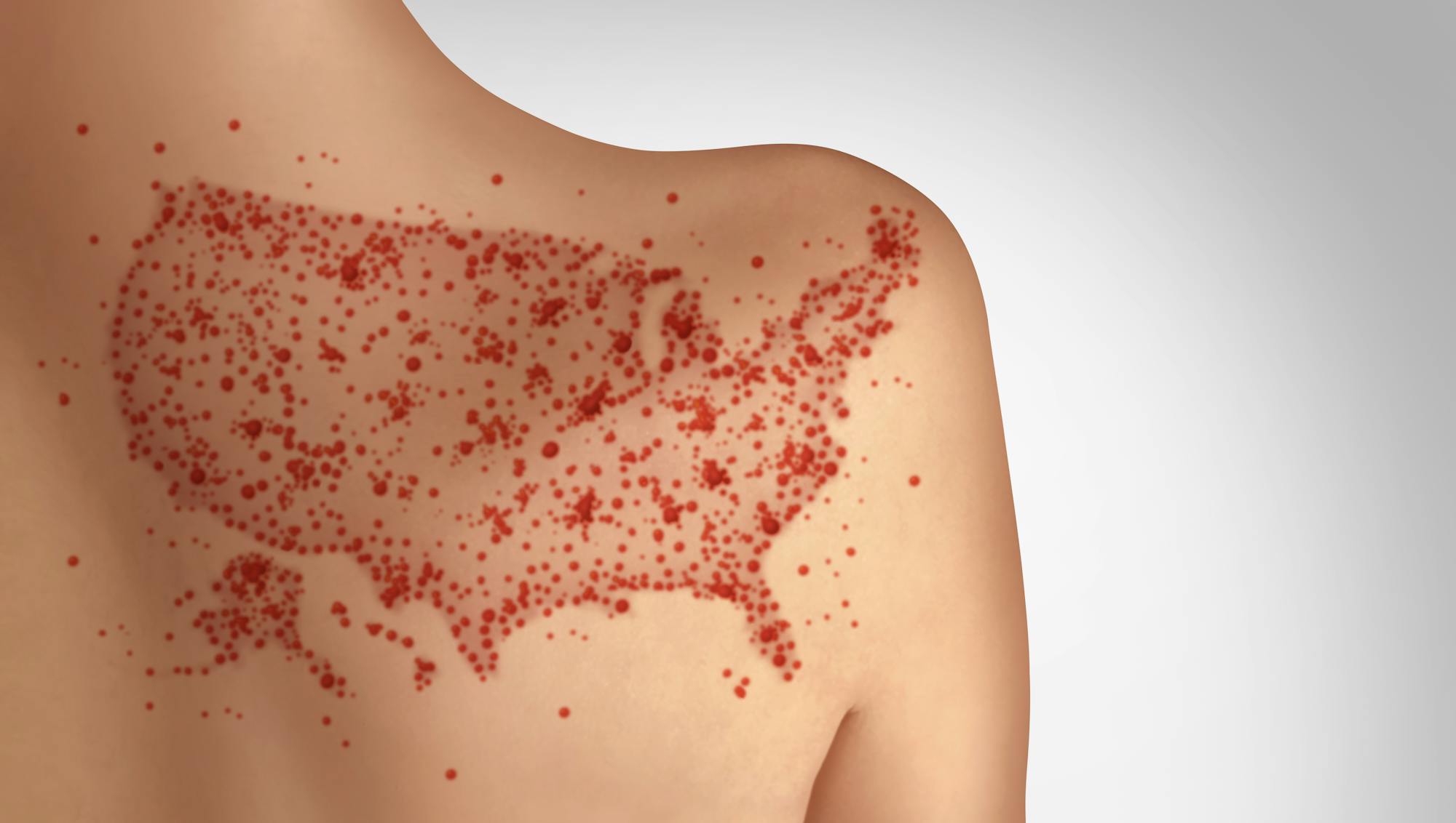 Measles can ravage the immune system and brain, causing long-term ...