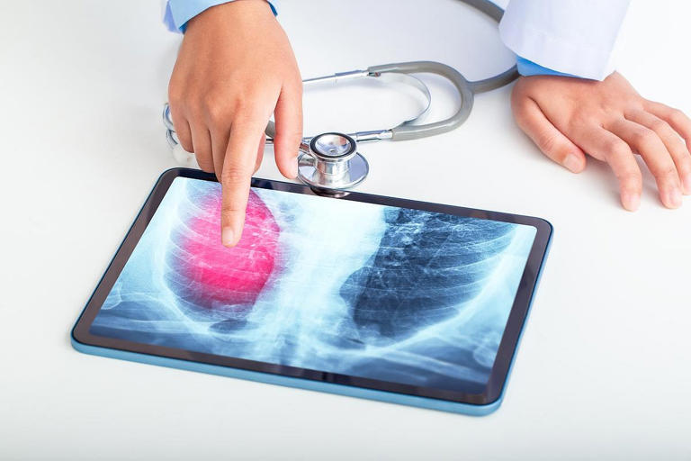 Lung Cancer Screening Up After 2021 Update to USPSTF Guidelines