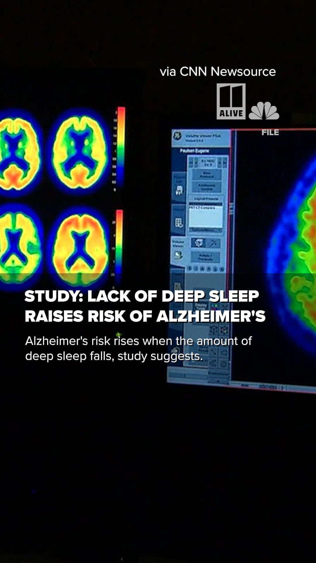 Study: Lack of deep sleep raises risk of Alzheimer's