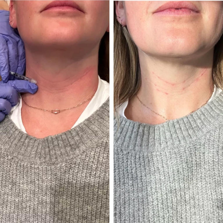I Got Neck Botox to Treat My Tech Neck Wrinkles - and It Worked
