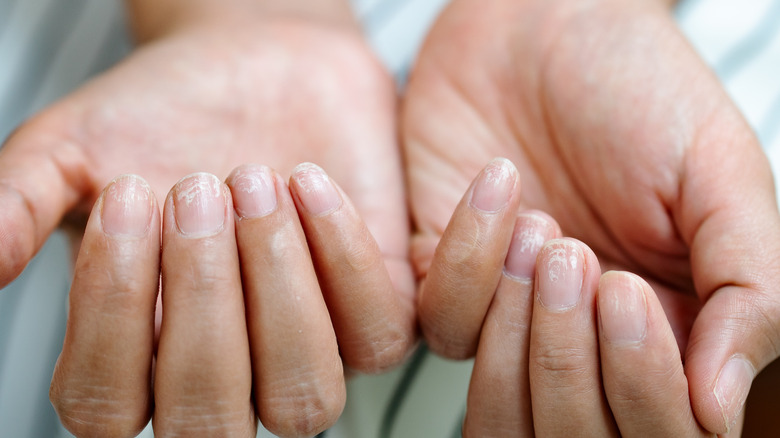 Signs You May Have Eggshell Nails (& What To Do About It)