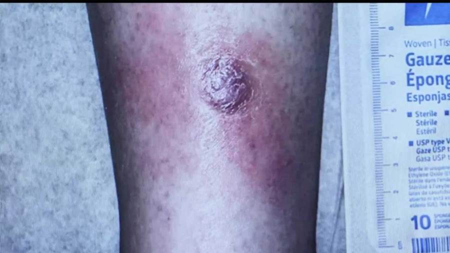 What to do if you feel a lump through your skin?