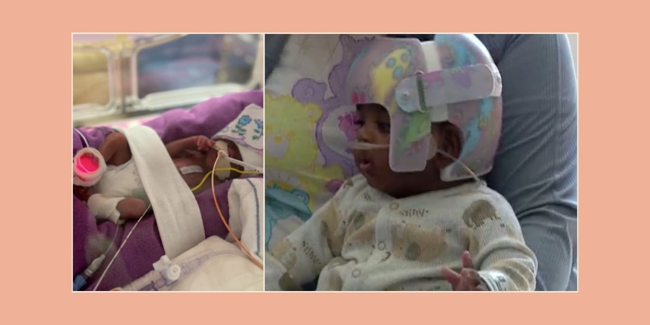 Tiny Minnesota miracle: One of the world’s smallest babies is finally ...