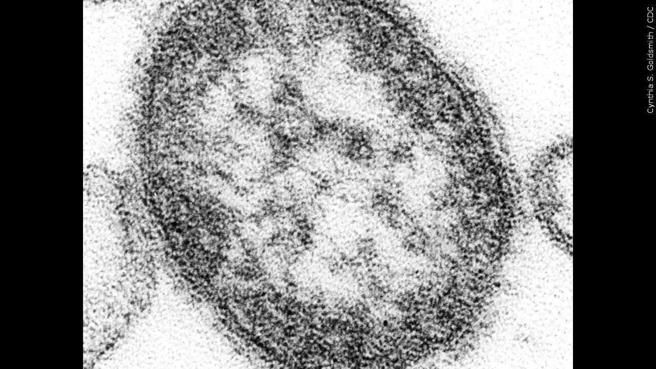 Possible measles exposure confirmed on Trinity Valley Community College ...