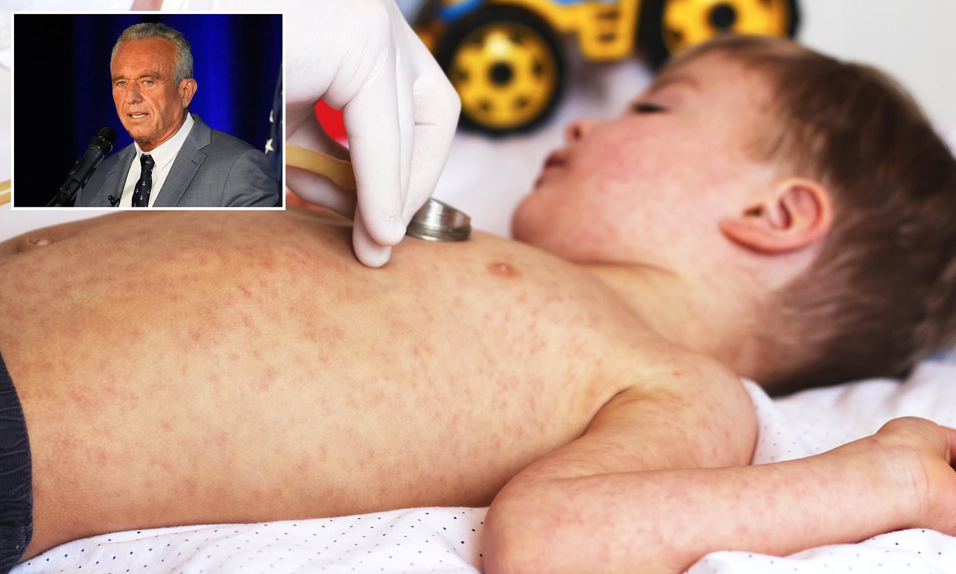 Texas children poisoned by unproven RFK Jr-backed vitamin for measles
