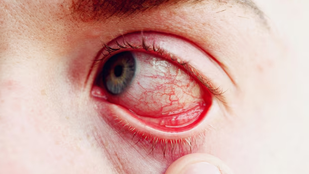 Eye Infection Is Common in Summer: These Tips Will Keep Your Eyes ...