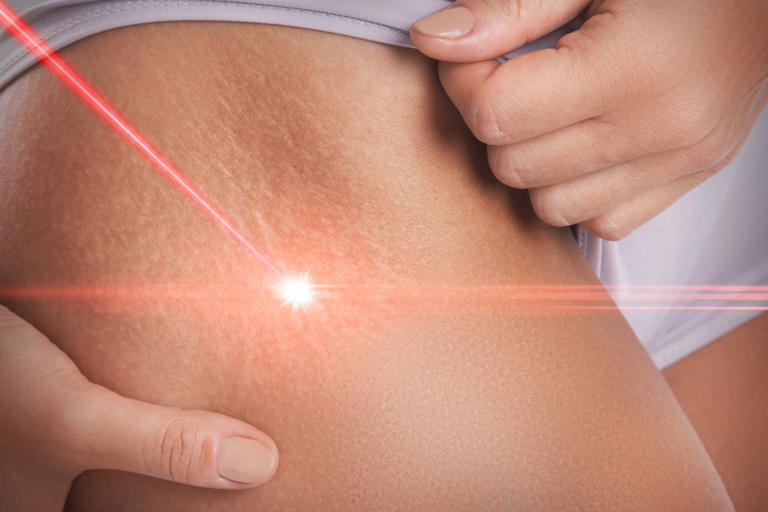 Wrinkles begone: Dermatologists reveal the best lasers for lines, sagging, stretch marks and spots